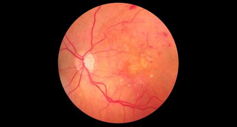 8 Eye Conditions Retinal Imaging Can Diagnose and Monitor - McRay ...